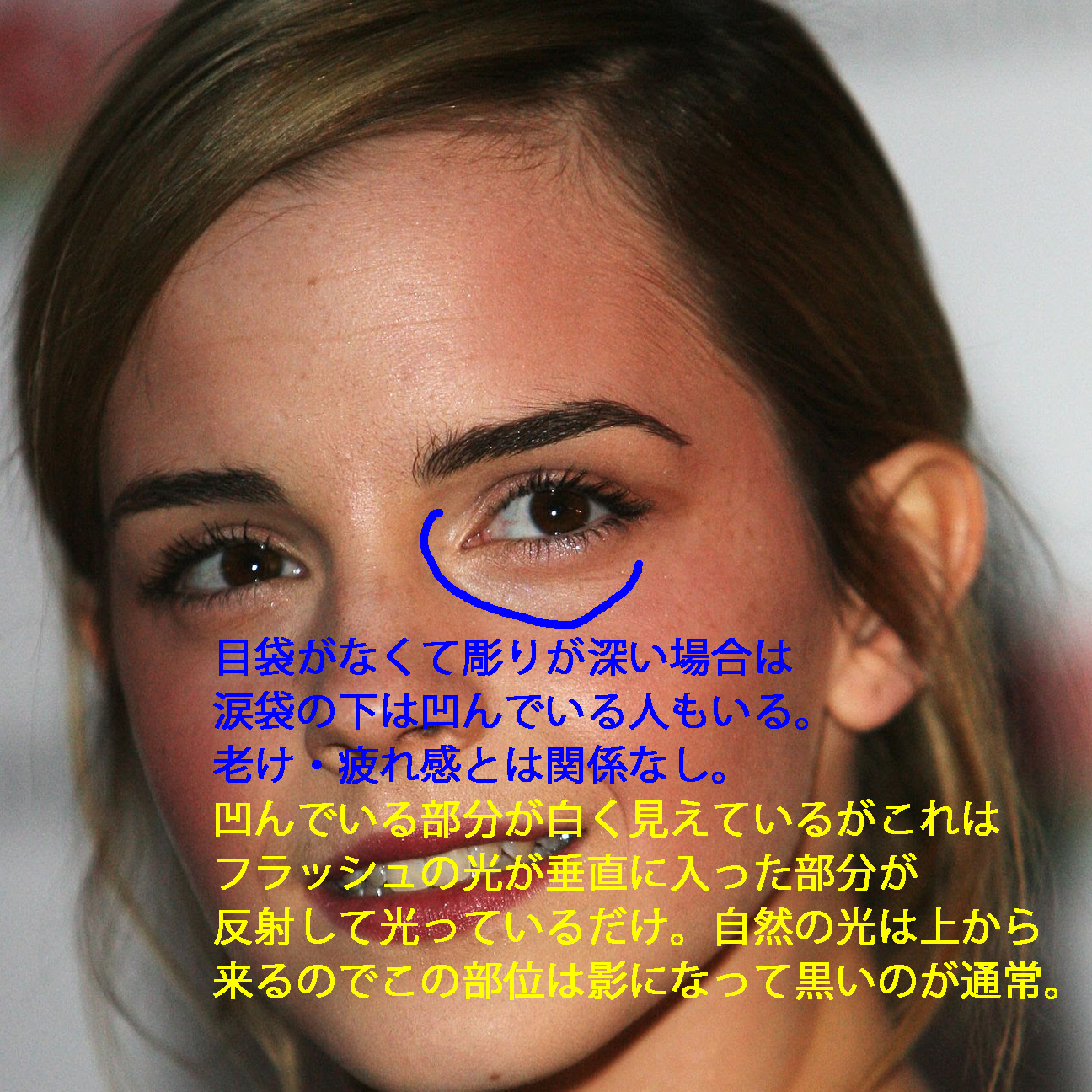 超絶美しいエマ・ワトソンさんの目の下は凹んでいる!?それはクマなの?? シンシア総院長ブログ~sincerely Yours 銀座の美容